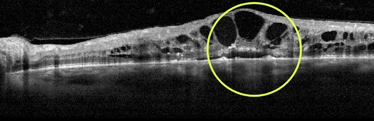 How VABYSMO™ (faricimab-svoa) May Help Treat RVO