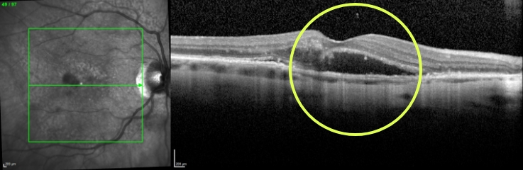How VABYSMO™ (faricimab-svoa) May Help Treat Wet AMD